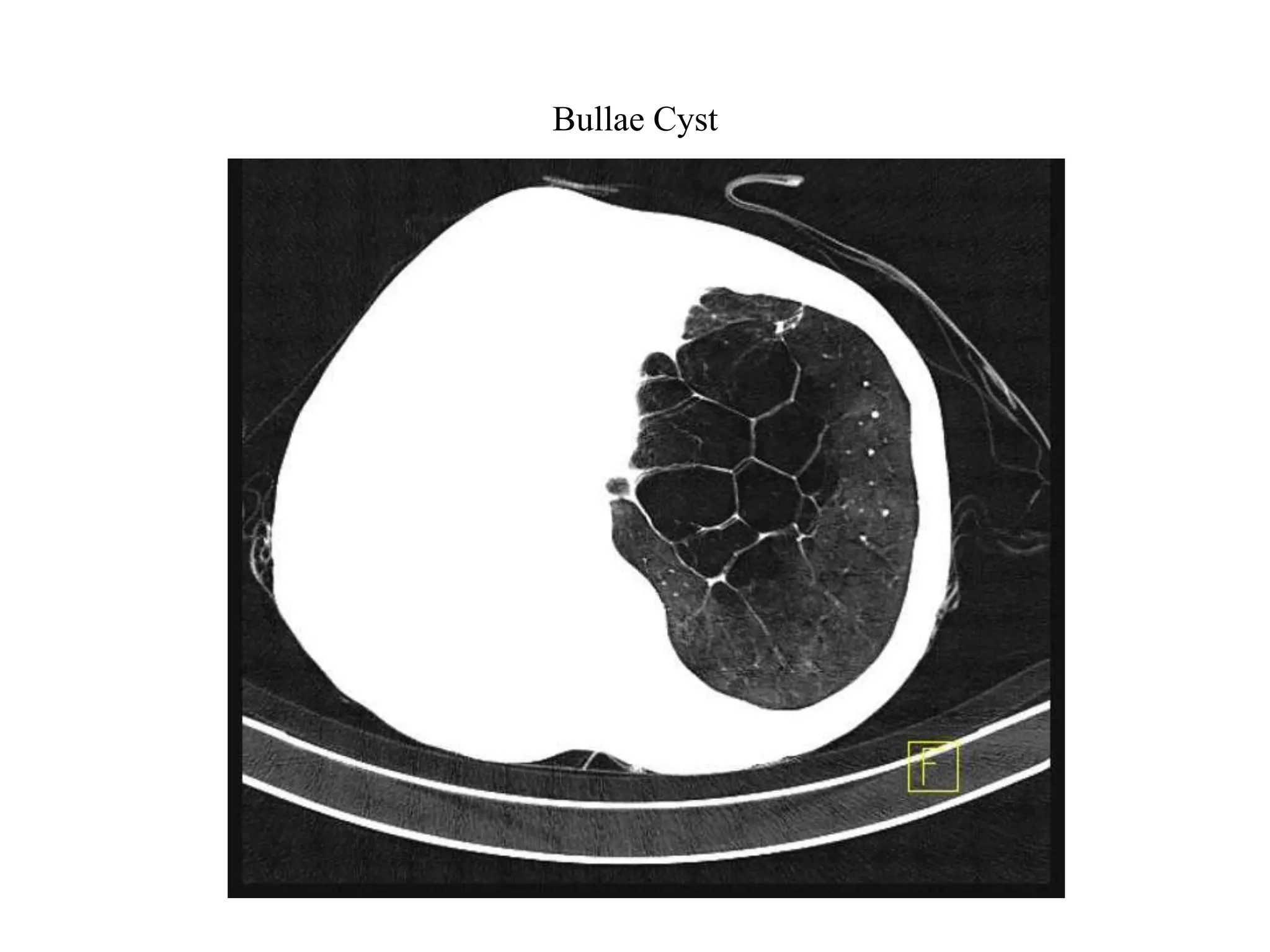 Differential diagnosis of pulmonary cyst: 1. Bullous Emphysema. 2 ...