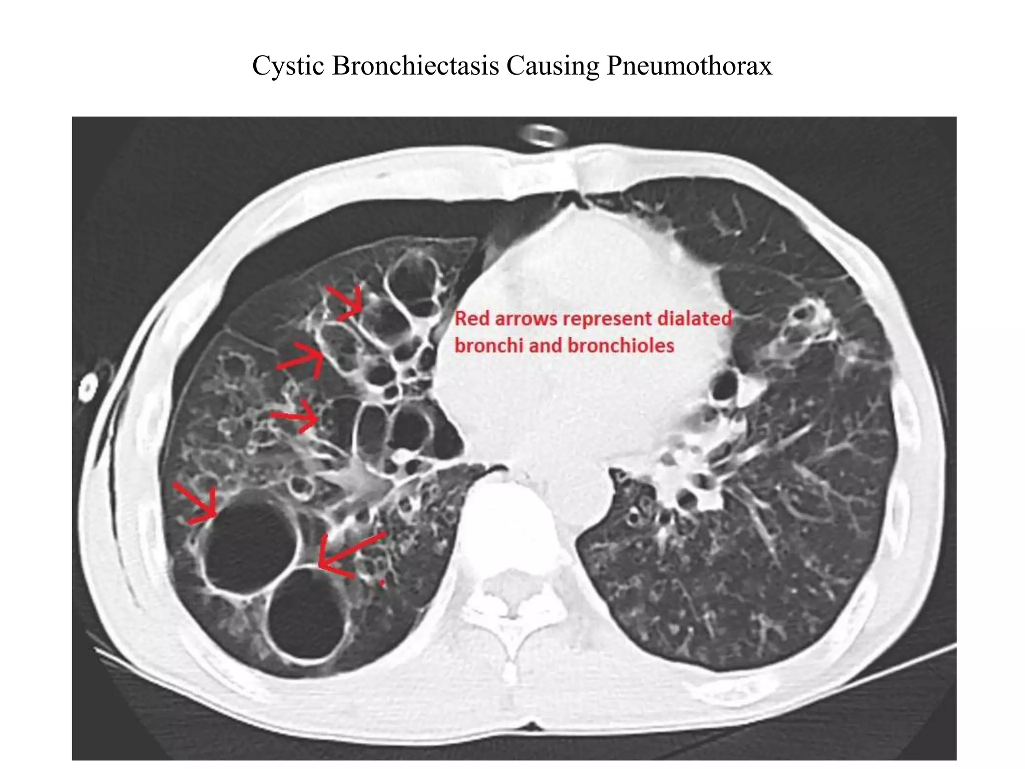 Differential diagnosis of pulmonary cyst: 1. Bullous Emphysema. 2 ...