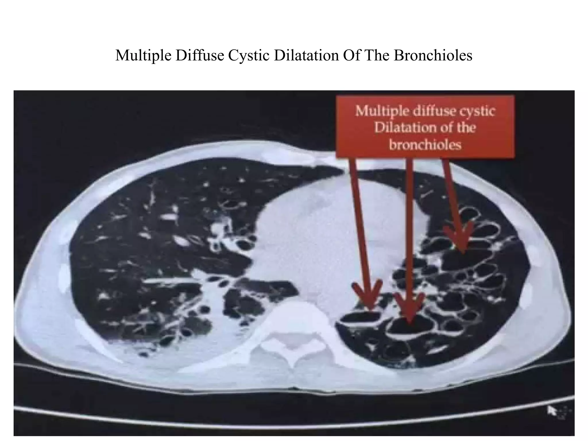Differential diagnosis of pulmonary cyst: 1. Bullous Emphysema. 2 ...