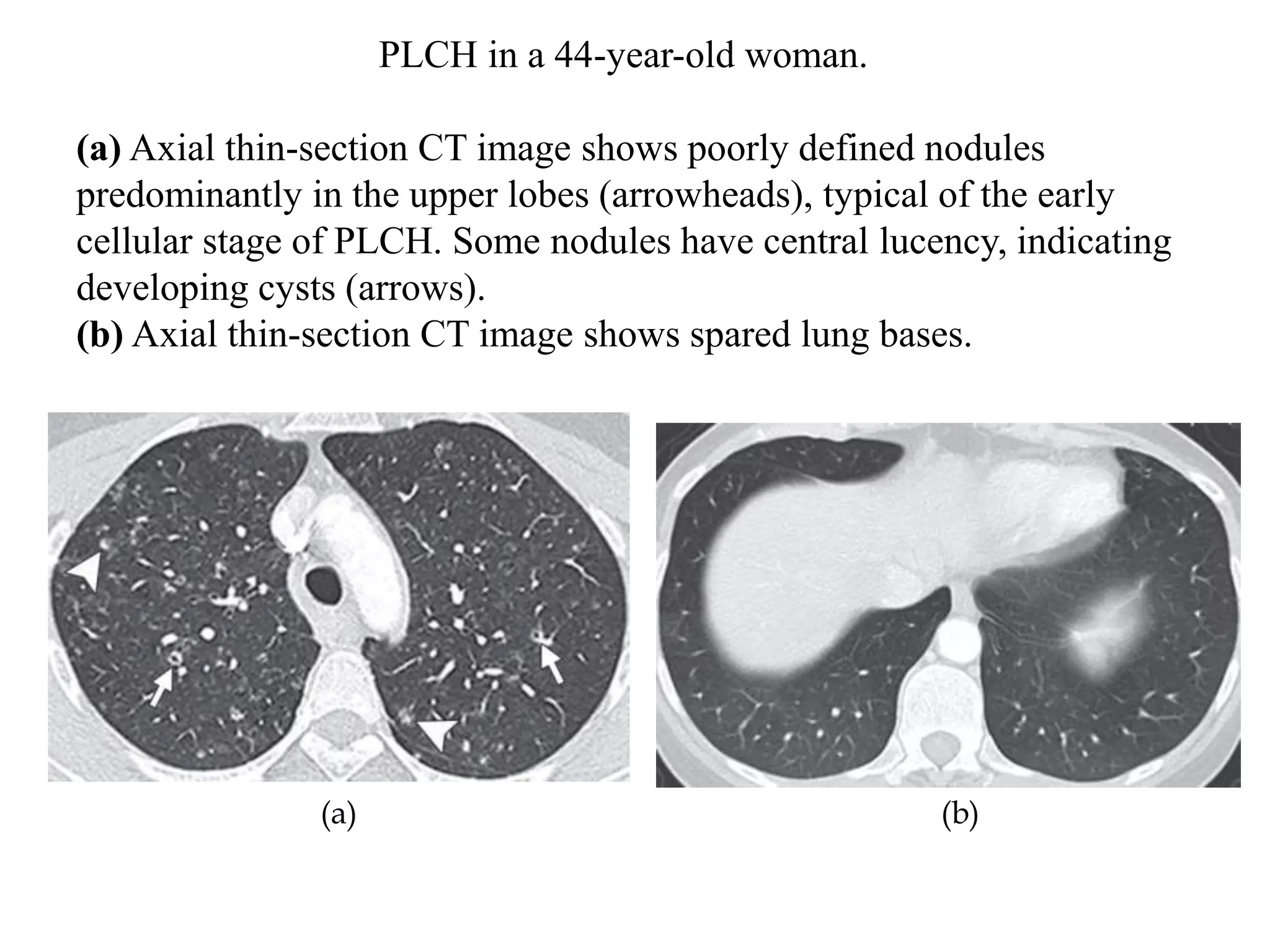 Differential diagnosis of pulmonary cyst: 1. Bullous Emphysema. 2 ...