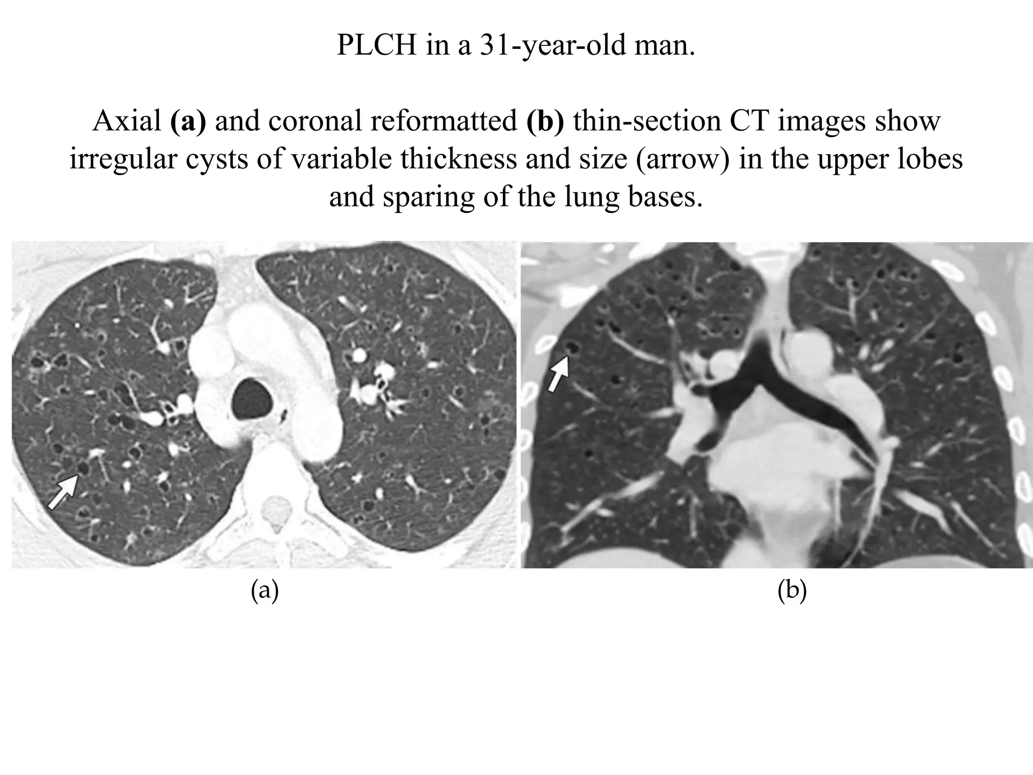 Differential diagnosis of pulmonary cyst: 1. Bullous Emphysema. 2 ...