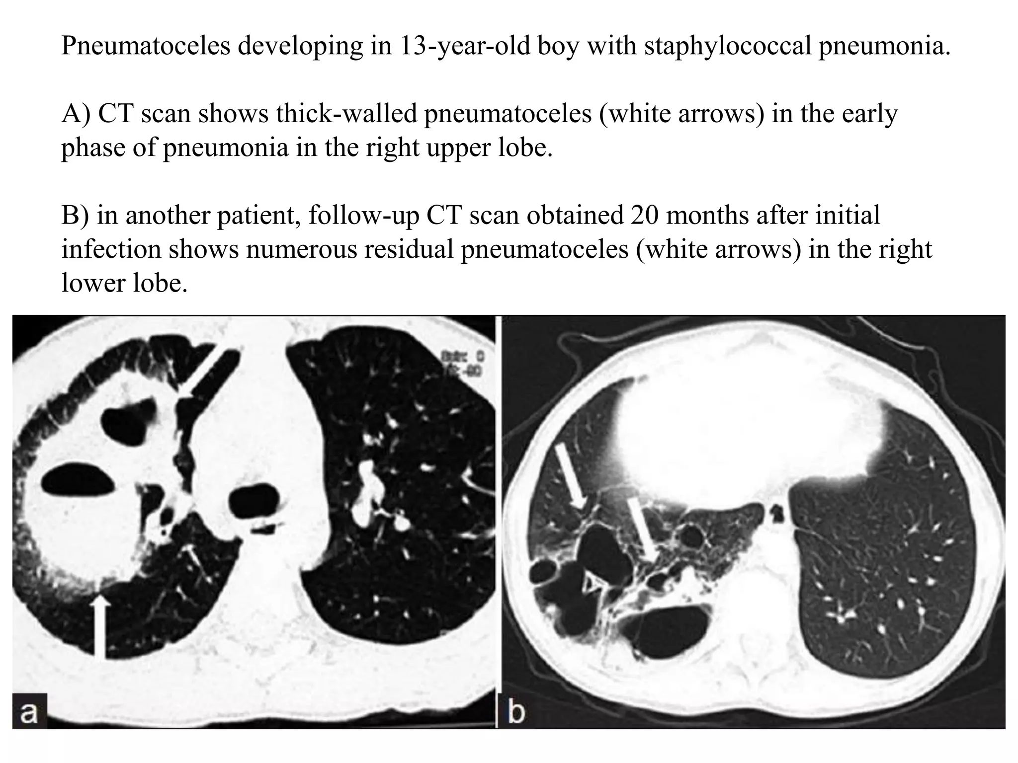 Differential diagnosis of pulmonary cyst: 1. Bullous Emphysema. 2 ...