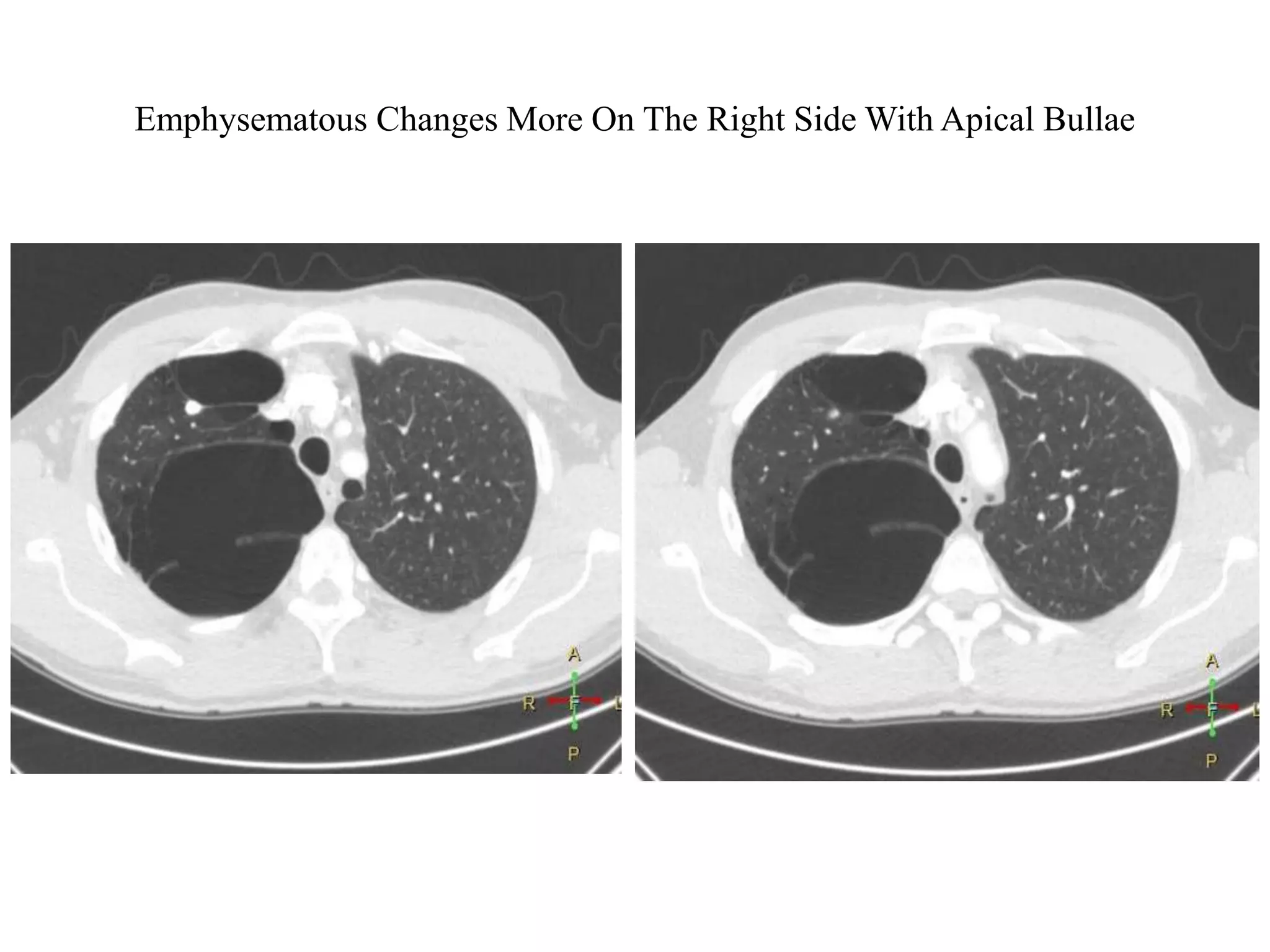 Differential diagnosis of pulmonary cyst: 1. Bullous Emphysema. 2 ...
