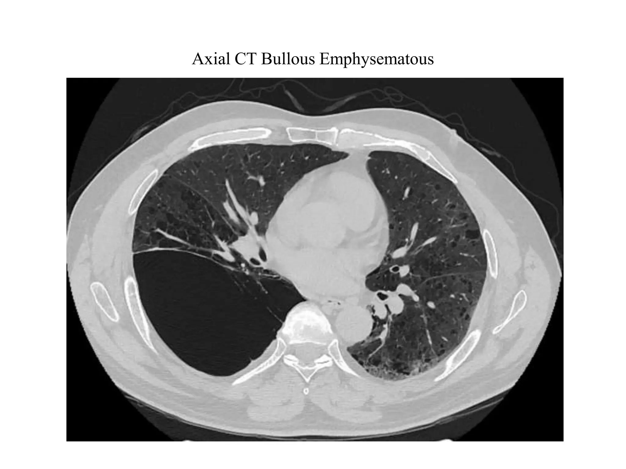 Differential diagnosis of pulmonary cyst: 1. Bullous Emphysema. 2 ...