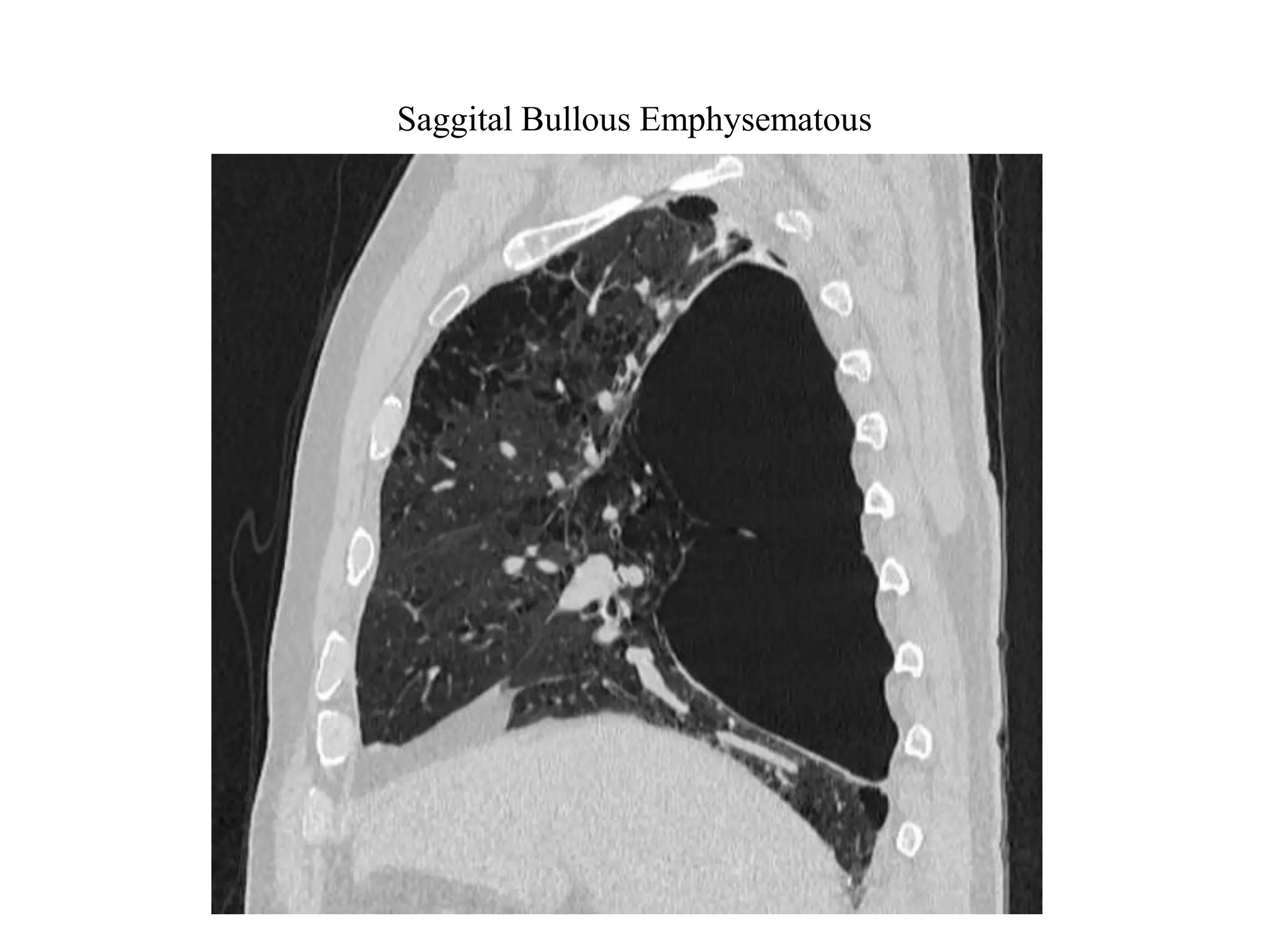 Differential diagnosis of pulmonary cyst: 1. Bullous Emphysema. 2 ...
