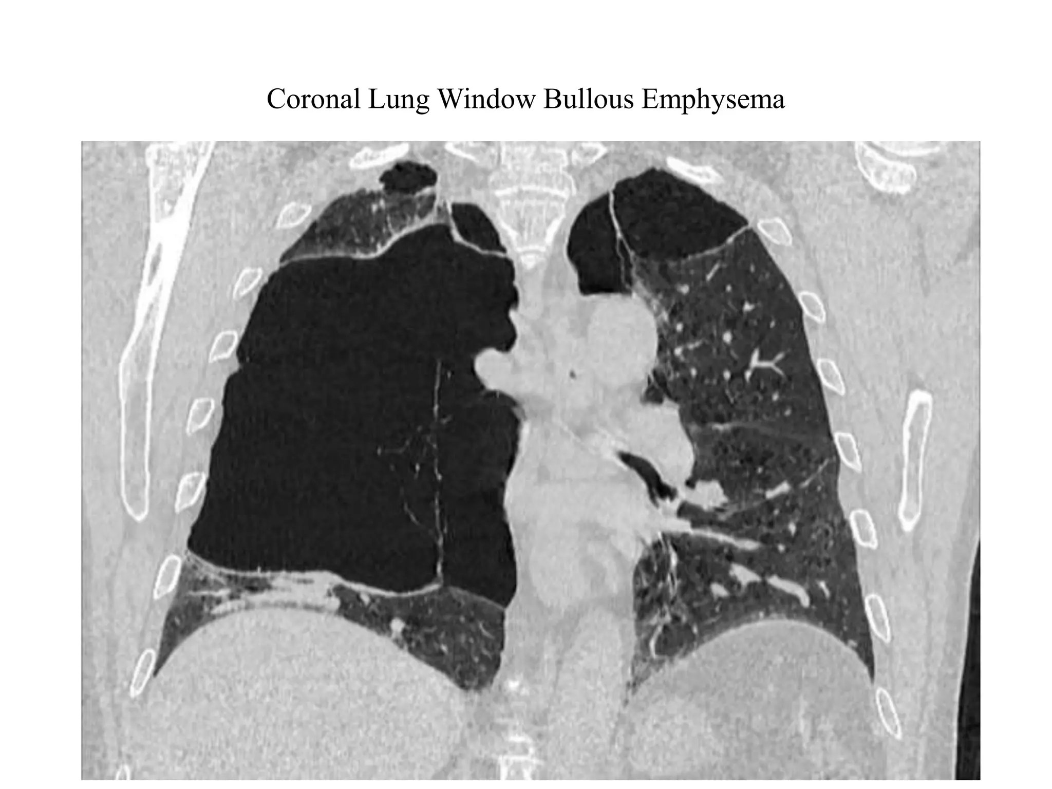 Differential diagnosis of pulmonary cyst: 1. Bullous Emphysema. 2 ...