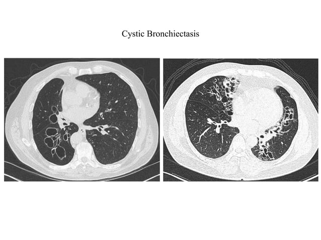 Differential diagnosis of pulmonary cyst: 1. Bullous Emphysema. 2 ...