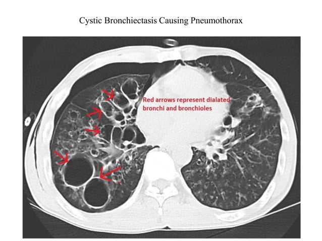 Differential diagnosis of pulmonary cyst: 1. Bullous Emphysema. 2 ...