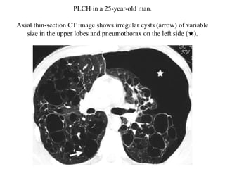 Differential diagnosis of pulmonary cyst: 1. Bullous Emphysema. 2 ...