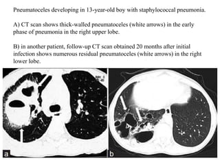 Differential diagnosis of pulmonary cyst: 1. Bullous Emphysema. 2 ...