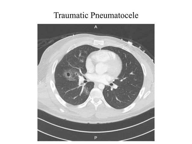 Differential diagnosis of pulmonary cyst: 1. Bullous Emphysema. 2 ...