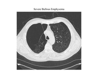 Differential diagnosis of pulmonary cyst: 1. Bullous Emphysema. 2 ...