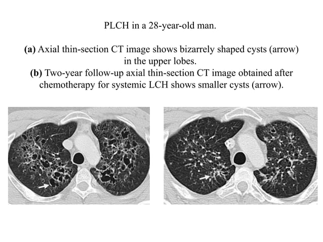 Differential diagnosis of pulmonary cyst: 1. Bullous Emphysema. 2 ...