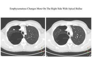 Bullous Emphysema