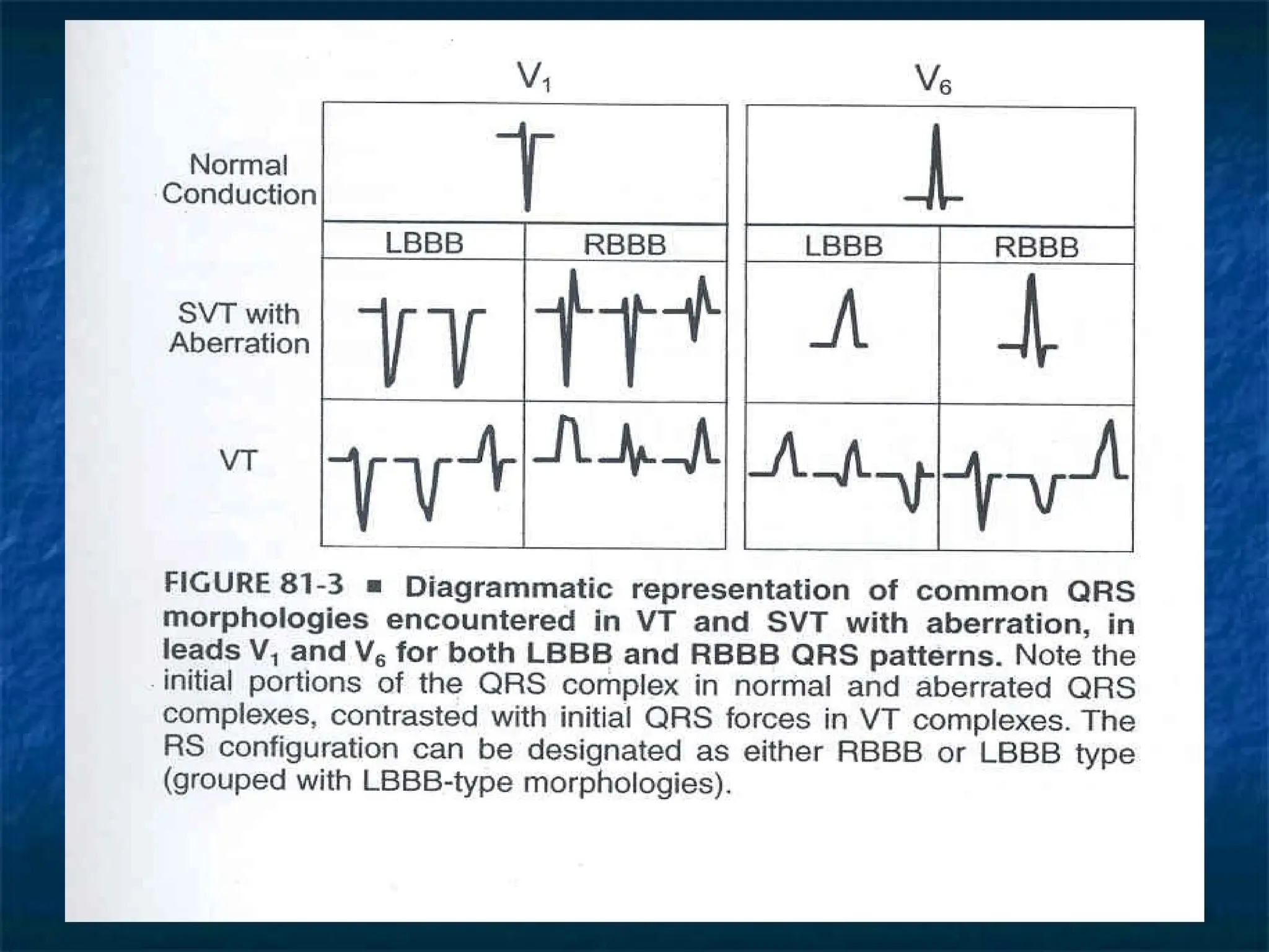 Differential Diagnosis of Tachycardias.ppt