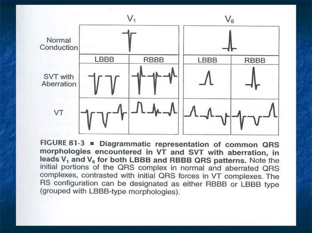 Differential Diagnosis of Tachycardias.ppt
