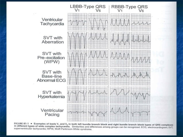 Differential Diagnosis of Tachycardias.ppt