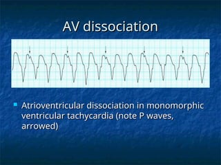 Differential Diagnosis of Tachycardias.ppt
