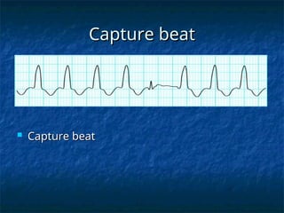 Differential Diagnosis of Tachycardias.ppt