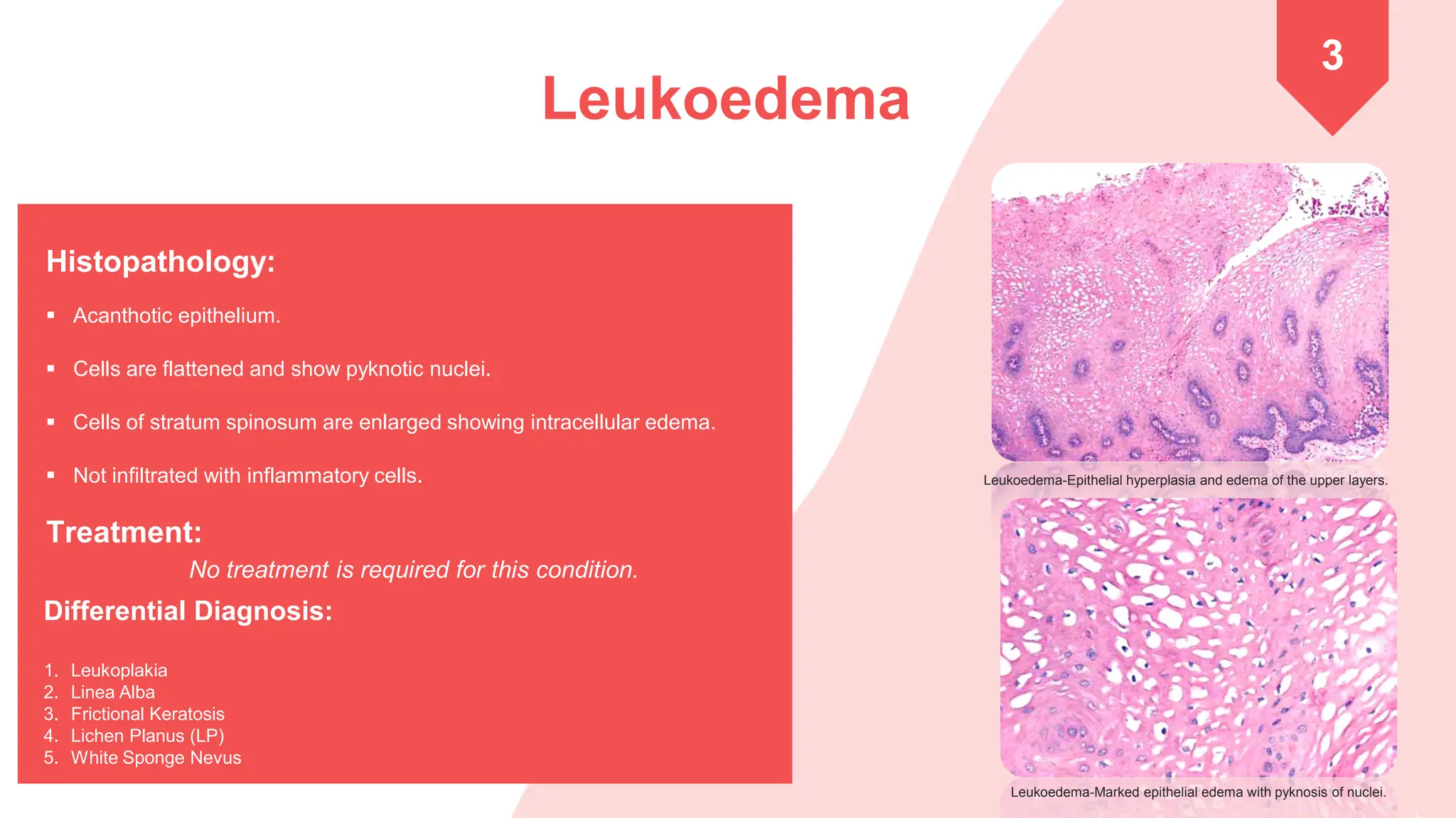 Differential Diagnosis of White Lesions in the oral cavity.pdf