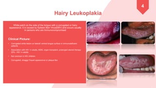 Differential Diagnosis of White Lesions in the oral cavity.pdf