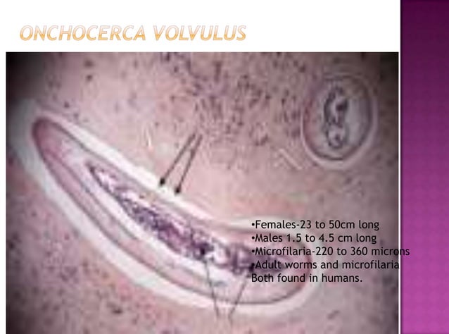Differential diagnosis of worms in the eye | PPT