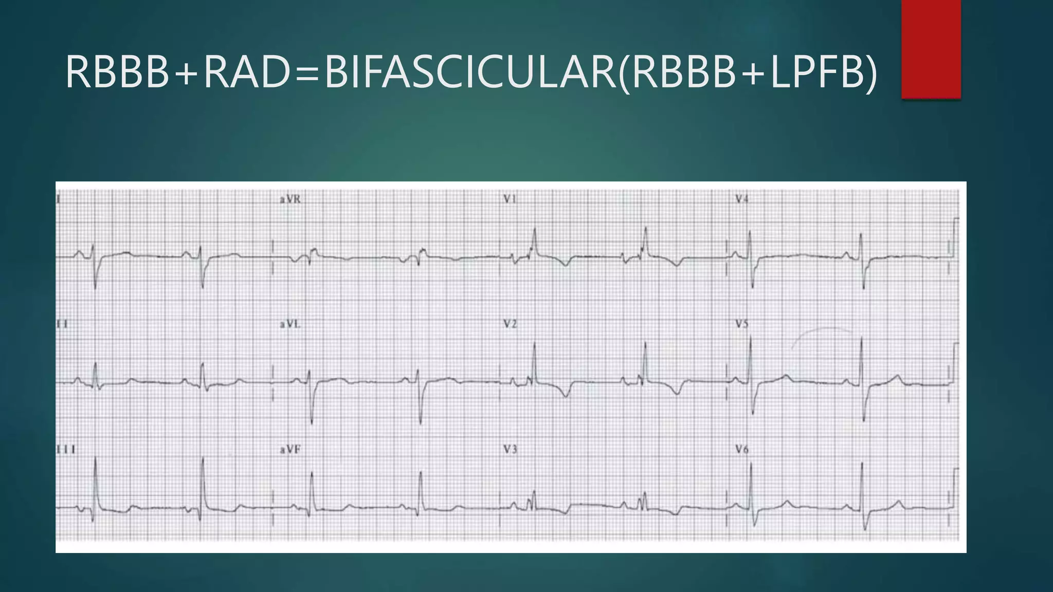 DIFFERENTIALS OF ARRYTHMIAS WITH RBBB MORPHOLOGY.pptx