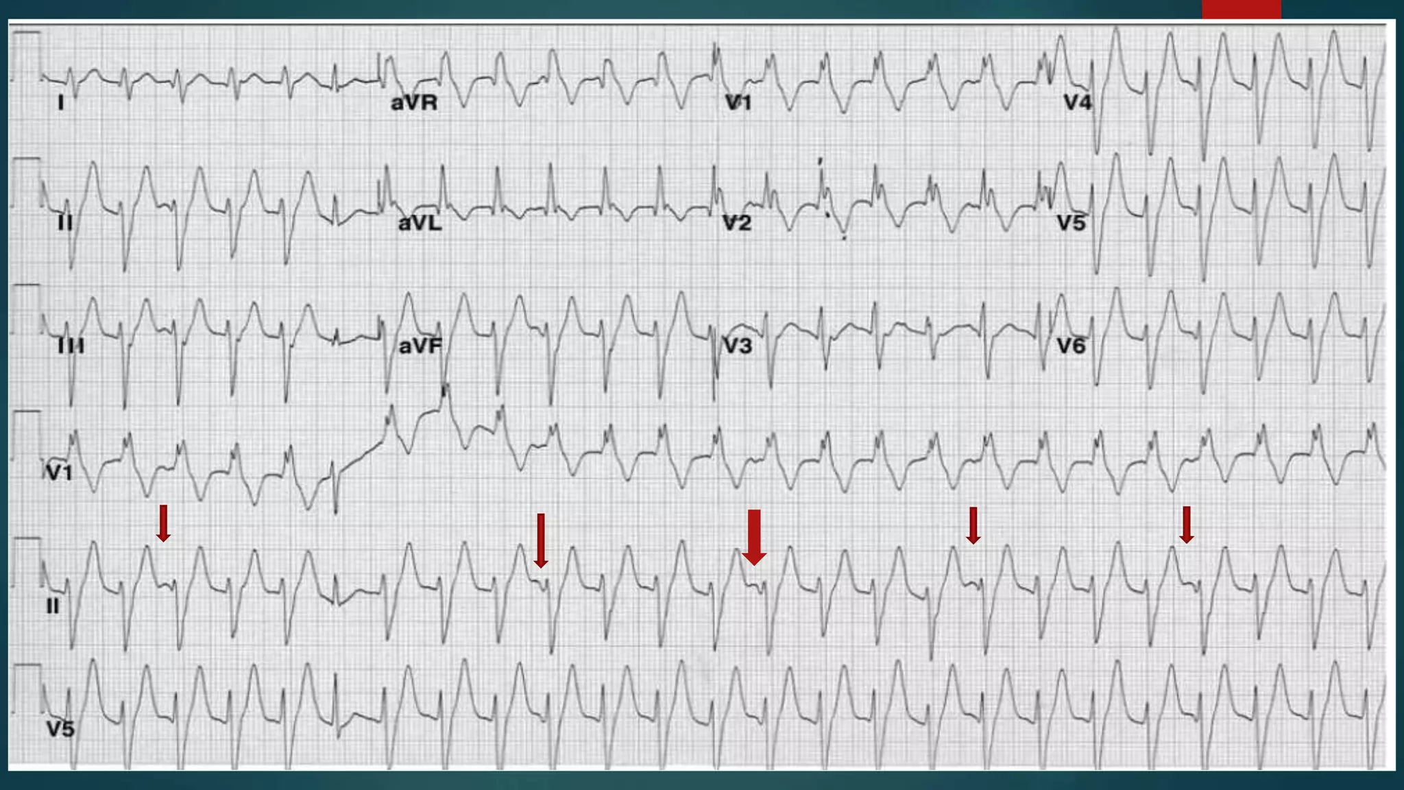 DIFFERENTIALS OF ARRYTHMIAS WITH RBBB MORPHOLOGY.pptx