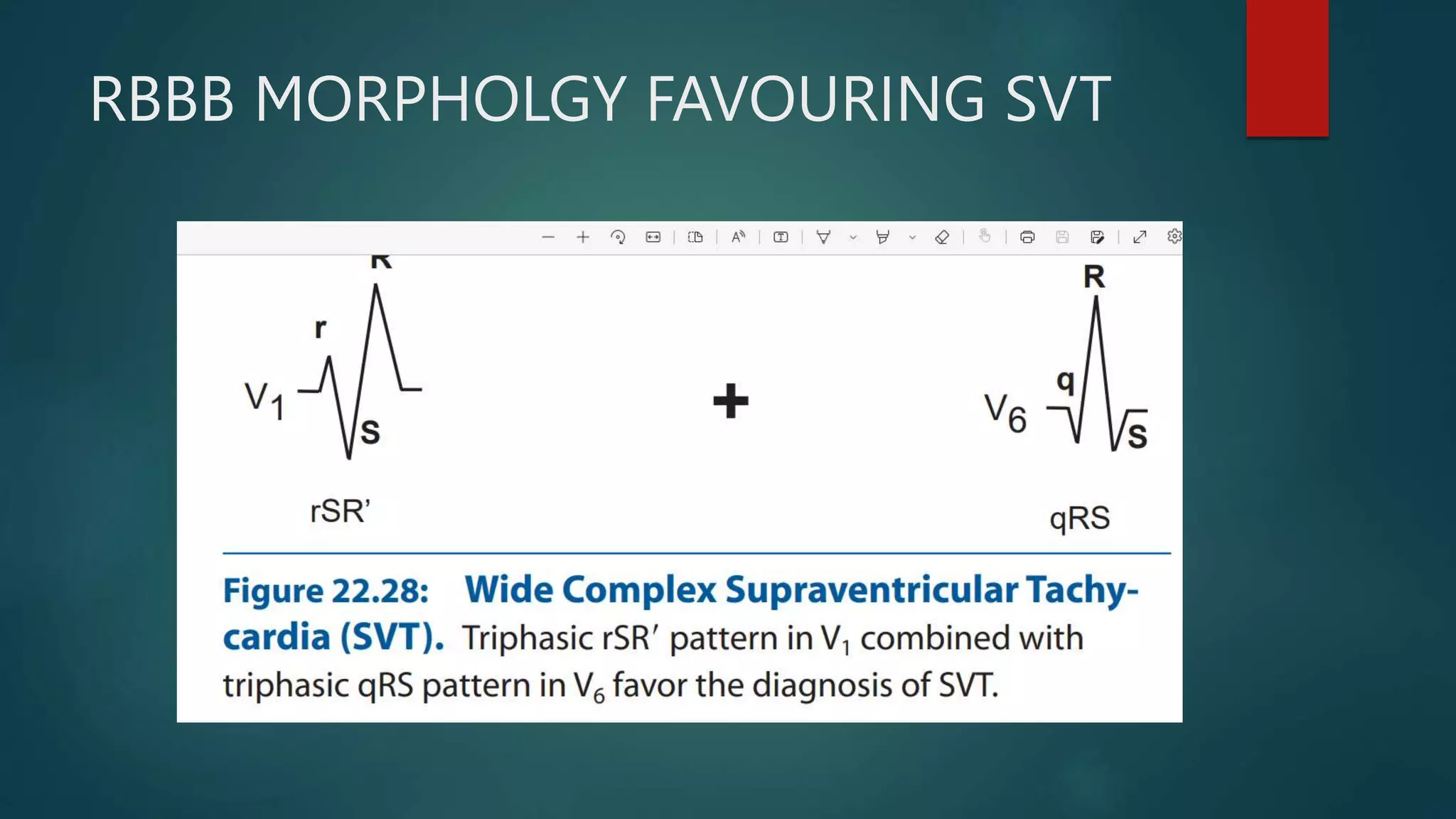 DIFFERENTIALS OF ARRYTHMIAS WITH RBBB MORPHOLOGY.pptx