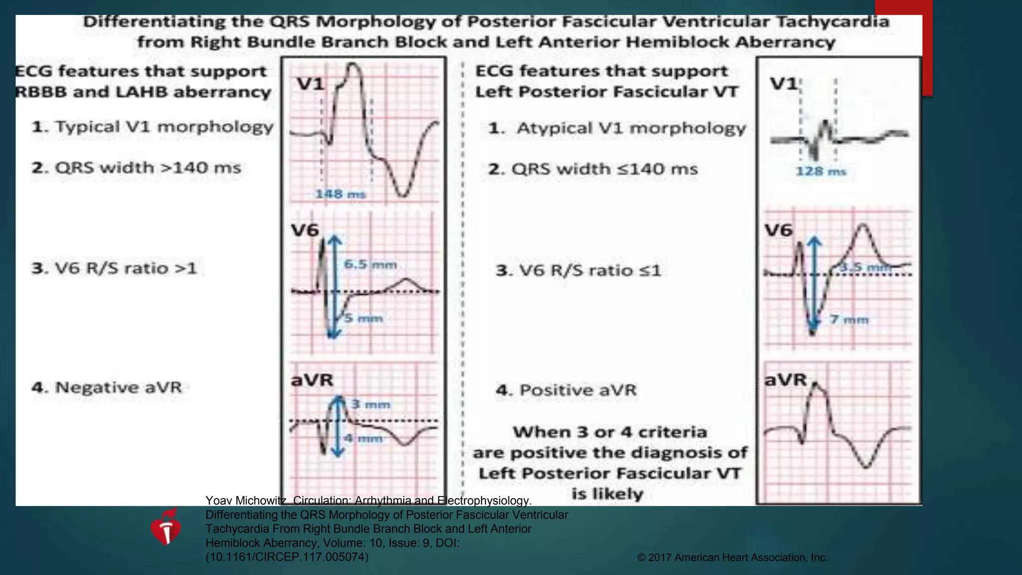 DIFFERENTIALS OF ARRYTHMIAS WITH RBBB MORPHOLOGY.pptx