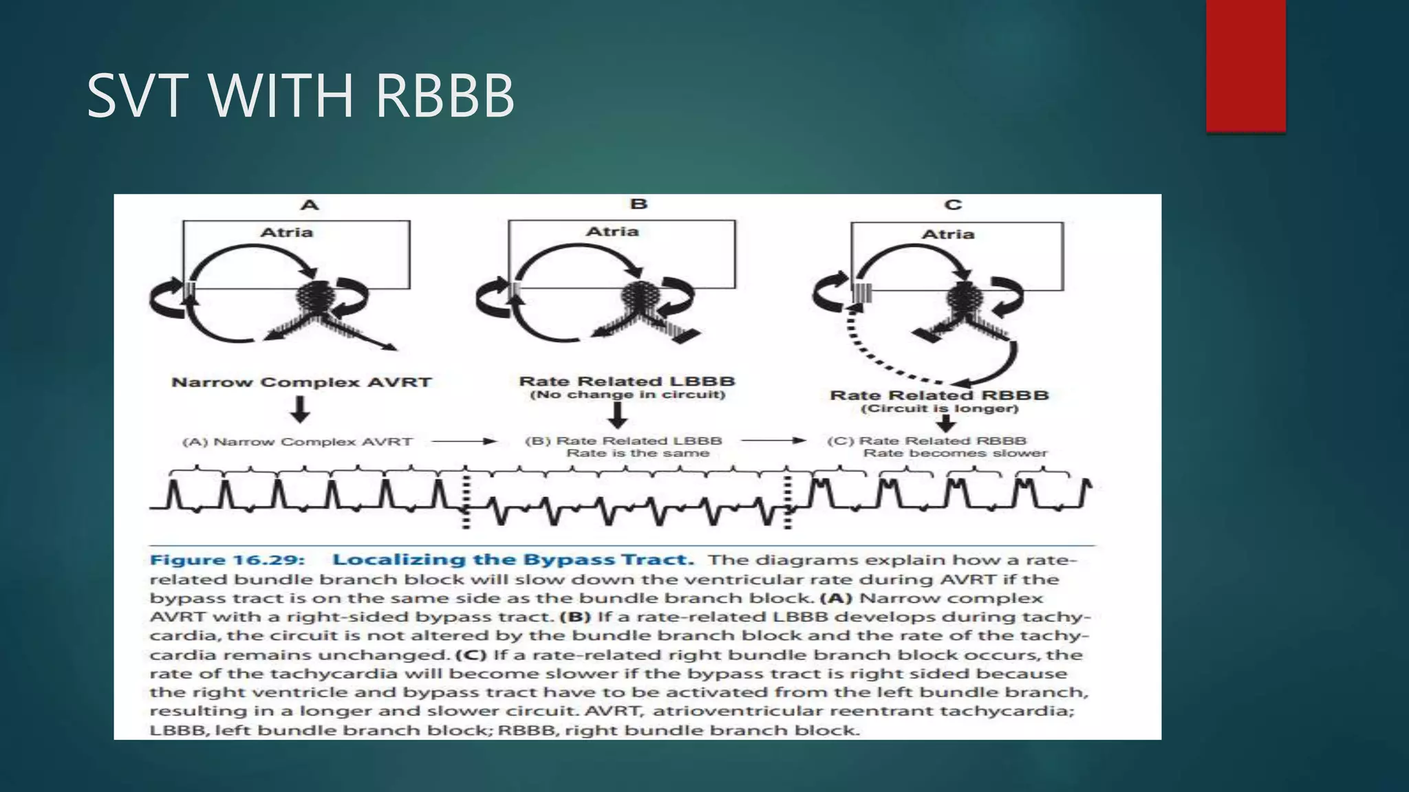 DIFFERENTIALS OF ARRYTHMIAS WITH RBBB MORPHOLOGY.pptx