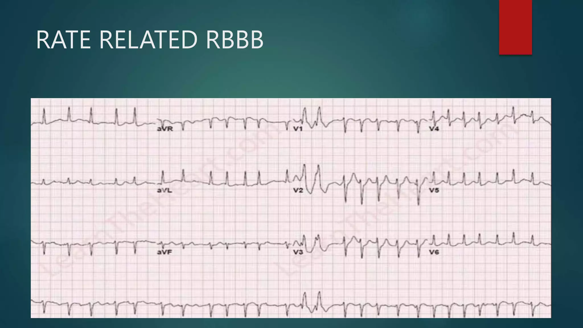 DIFFERENTIALS OF ARRYTHMIAS WITH RBBB MORPHOLOGY.pptx