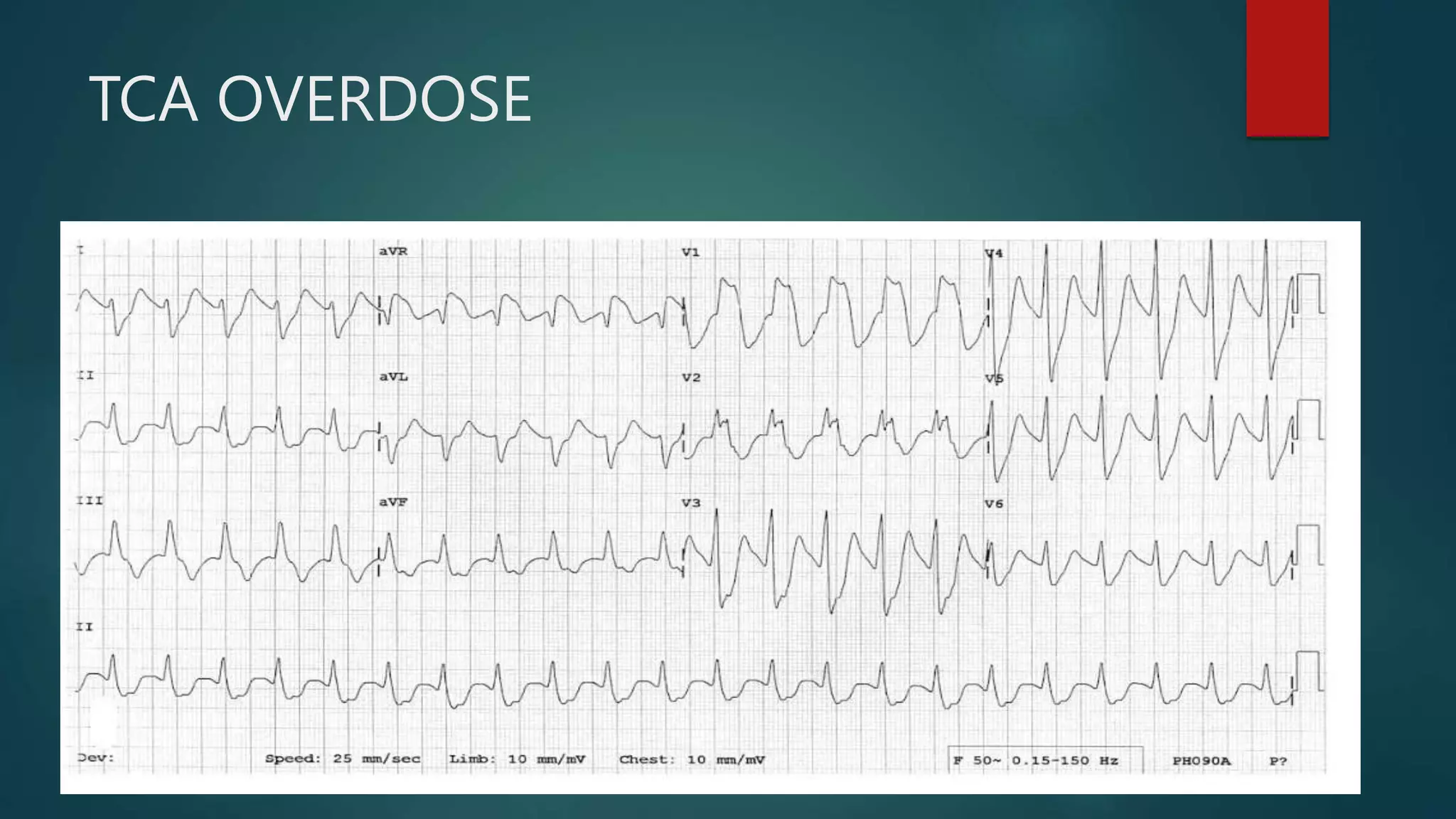 DIFFERENTIALS OF ARRYTHMIAS WITH RBBB MORPHOLOGY.pptx