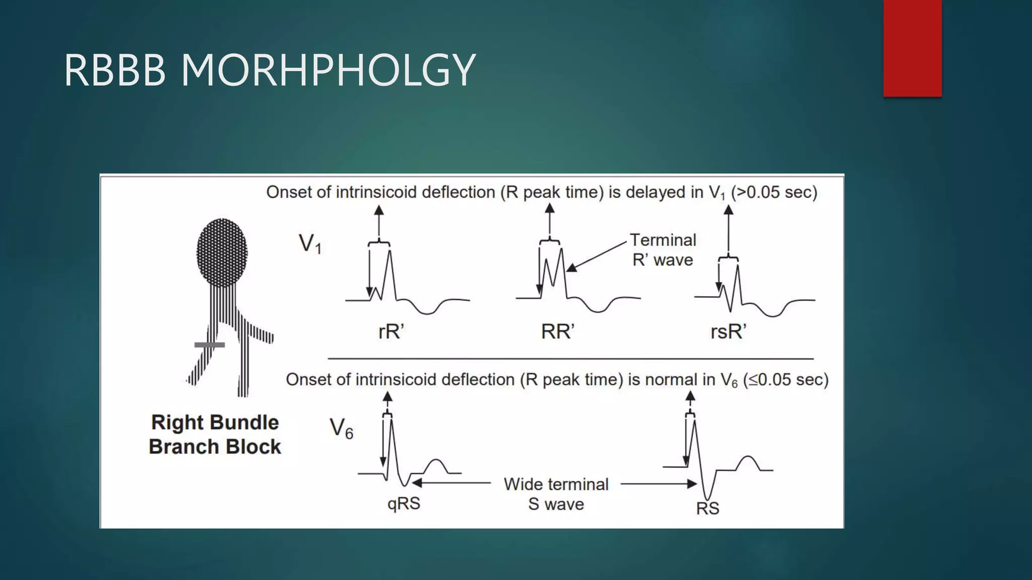 DIFFERENTIALS OF ARRYTHMIAS WITH RBBB MORPHOLOGY.pptx