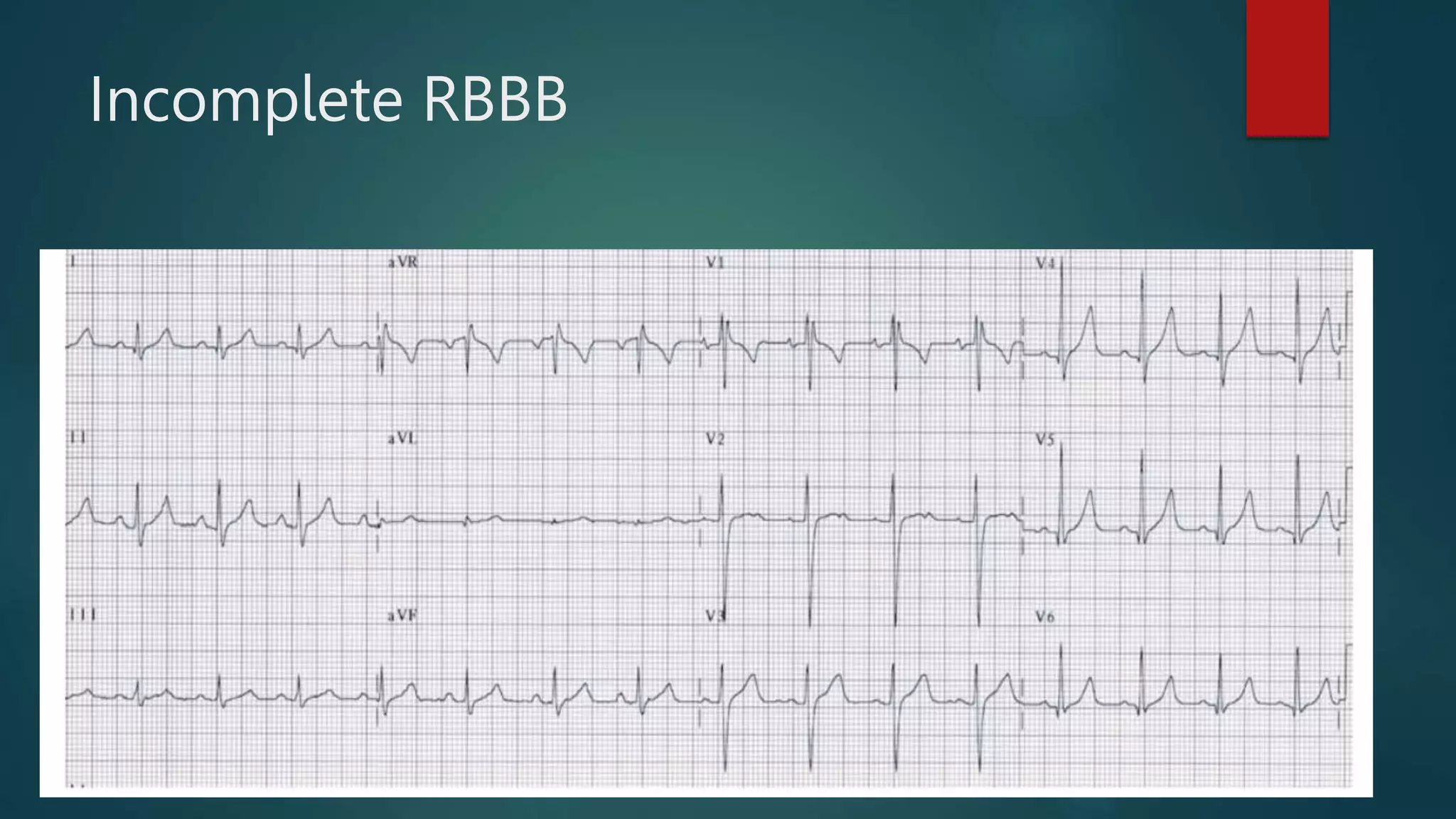 DIFFERENTIALS OF ARRYTHMIAS WITH RBBB MORPHOLOGY.pptx