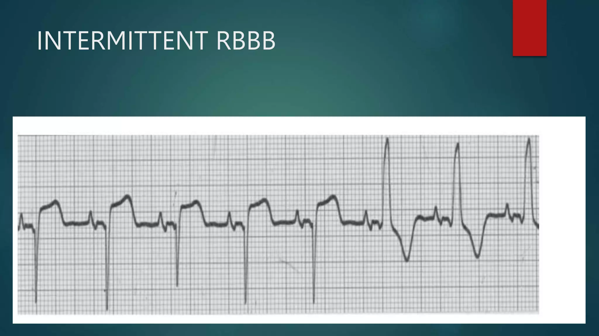 DIFFERENTIALS OF ARRYTHMIAS WITH RBBB MORPHOLOGY.pptx