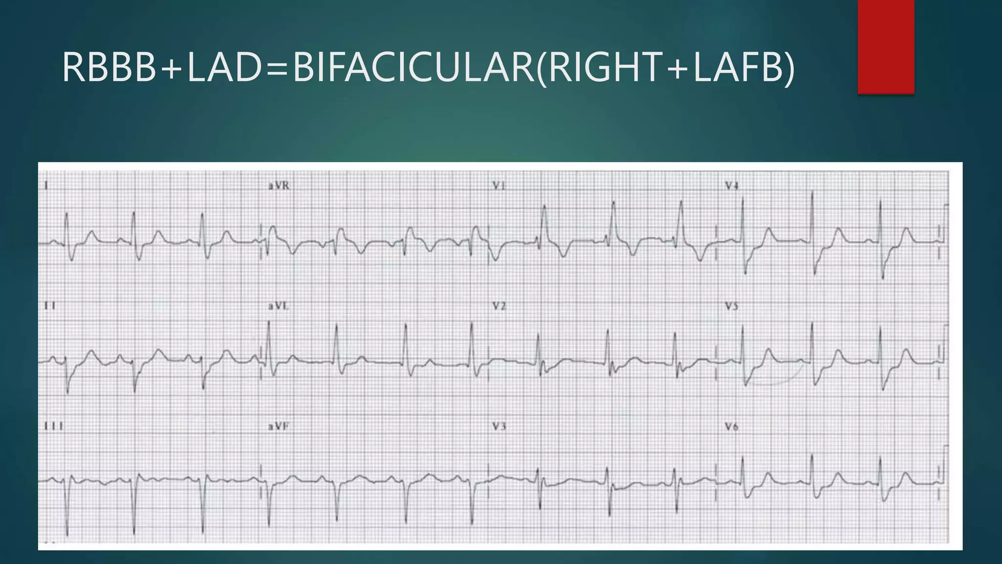 DIFFERENTIALS OF ARRYTHMIAS WITH RBBB MORPHOLOGY.pptx