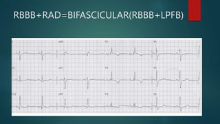 DIFFERENTIALS OF ARRYTHMIAS WITH RBBB MORPHOLOGY.pptx