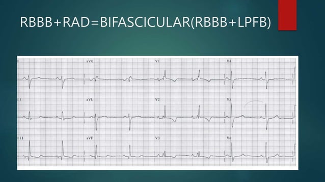 DIFFERENTIALS OF ARRYTHMIAS WITH RBBB MORPHOLOGY.pptx