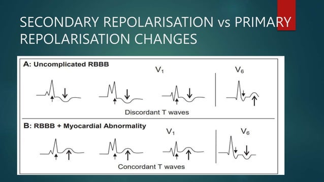 DIFFERENTIALS OF ARRYTHMIAS WITH RBBB MORPHOLOGY.pptx