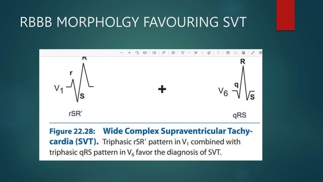 DIFFERENTIALS OF ARRYTHMIAS WITH RBBB MORPHOLOGY.pptx
