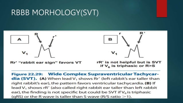 DIFFERENTIALS OF ARRYTHMIAS WITH RBBB MORPHOLOGY.pptx