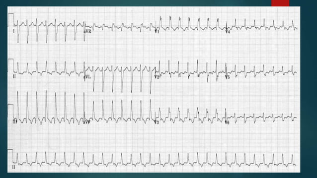 DIFFERENTIALS OF ARRYTHMIAS WITH RBBB MORPHOLOGY.pptx