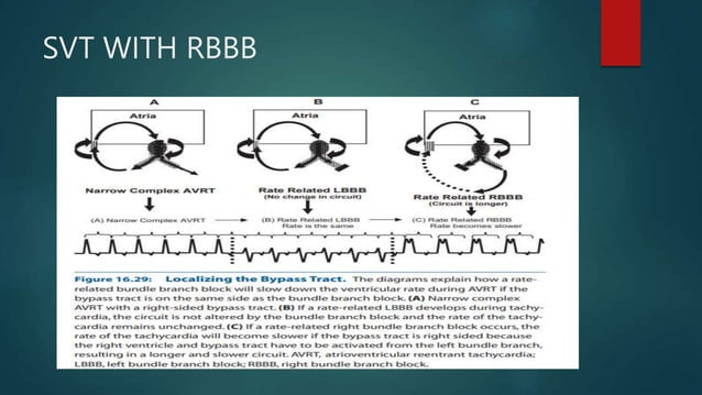 DIFFERENTIALS OF ARRYTHMIAS WITH RBBB MORPHOLOGY.pptx