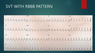 DIFFERENTIALS OF ARRYTHMIAS WITH RBBB MORPHOLOGY.pptx