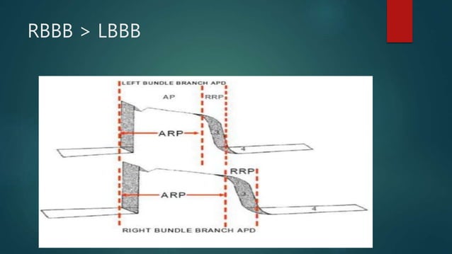 DIFFERENTIALS OF ARRYTHMIAS WITH RBBB MORPHOLOGY.pptx