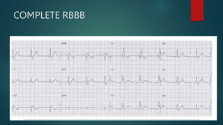 DIFFERENTIALS OF ARRYTHMIAS WITH RBBB MORPHOLOGY.pptx