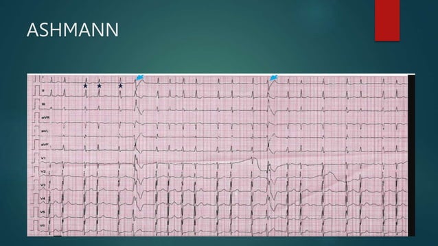 DIFFERENTIALS OF ARRYTHMIAS WITH RBBB MORPHOLOGY.pptx