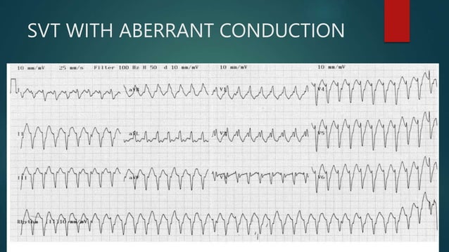 DIFFERENTIALS OF ARRYTHMIAS WITH RBBB MORPHOLOGY.pptx