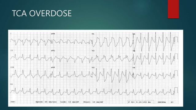 DIFFERENTIALS OF ARRYTHMIAS WITH RBBB MORPHOLOGY.pptx
